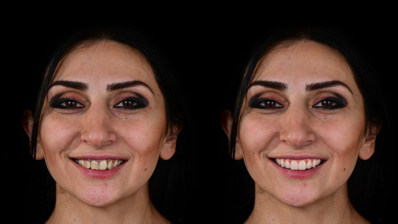 Gallery | Dental Treatment Simulation & Smile Design Software