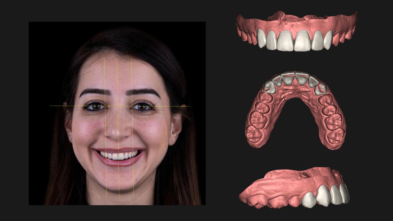 Gallery | Dental Treatment Simulation & Smile Design Software