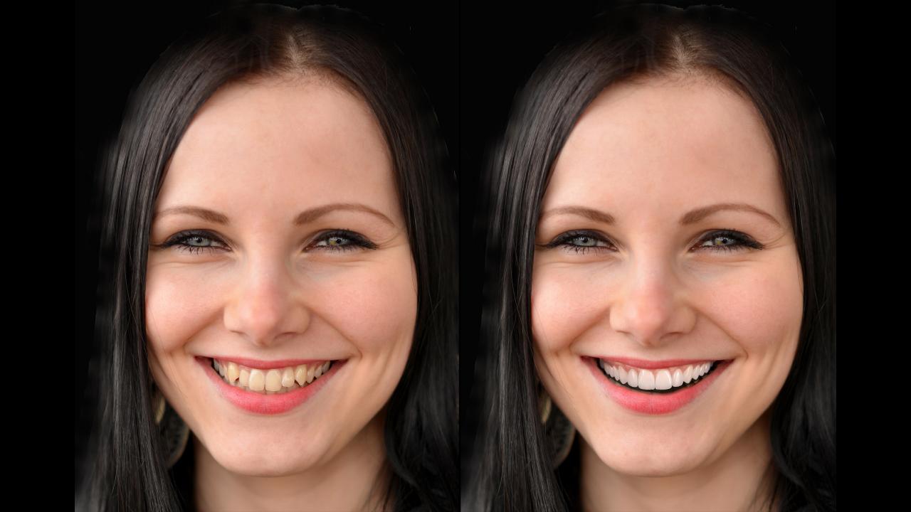 Gallery | Dental Treatment Simulation & Smile Design Software