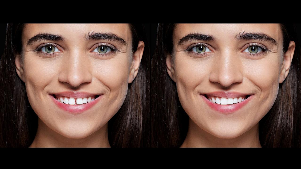 Gallery | Dental Treatment Simulation & Smile Design Software