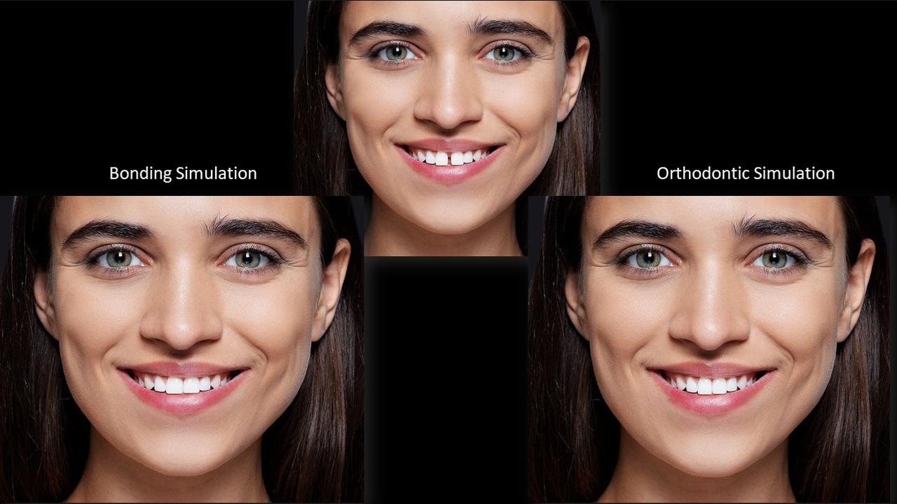 Gallery | Dental Treatment Simulation & Smile Design Software